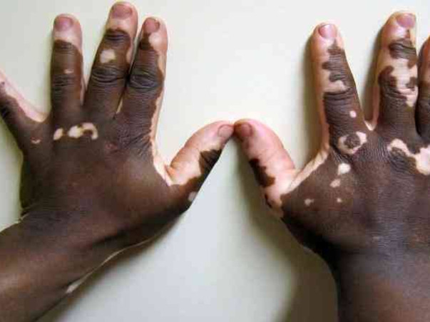 Help People Suffering From Vitiligo/Leucoderma