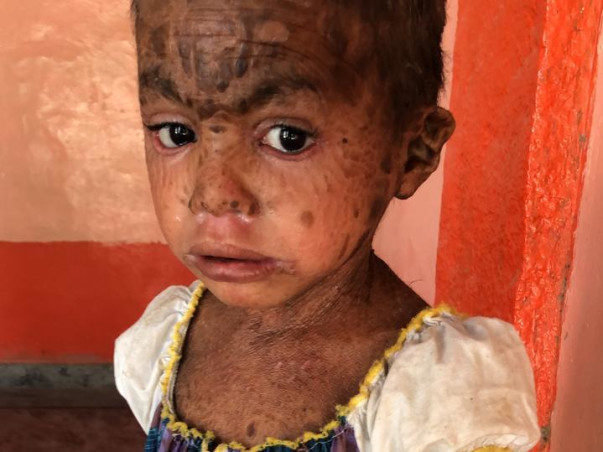 Support Ramjaana B Recover From This Rare Skin Disease