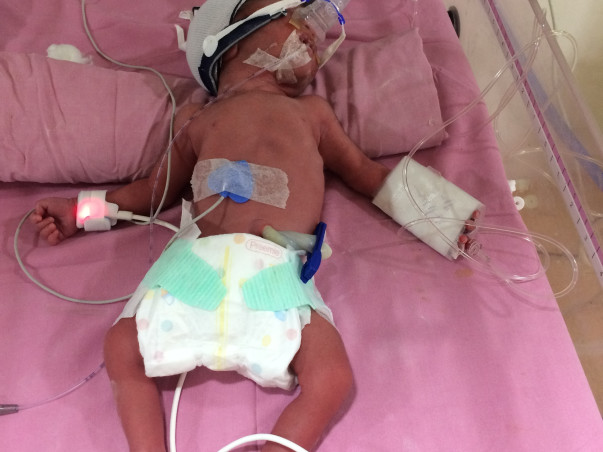 Support Baby Of Shweta Recover From Preterm Birth