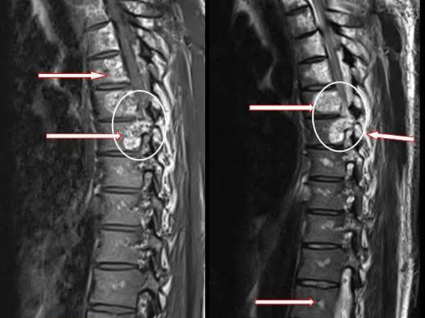 Help my cousin fight Spinal angioma