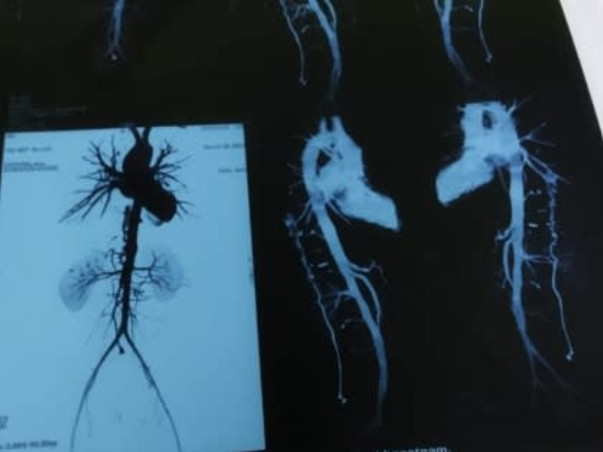 Help my cousin fight Spinal angioma