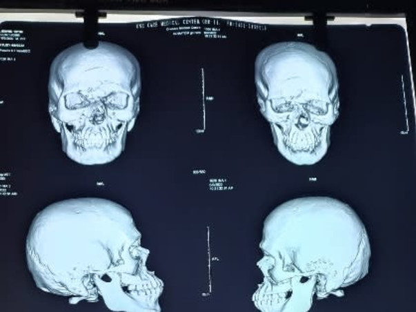 Help My Brother Recover From Accidental Head Injuries